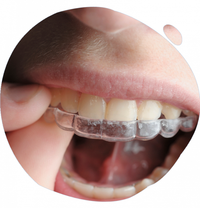 Invisalign - Clear Aligners Madurai - Magizchi Dental